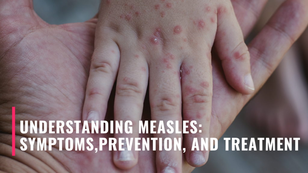 Understanding Measles: Symptoms, Prevention, and Treatment